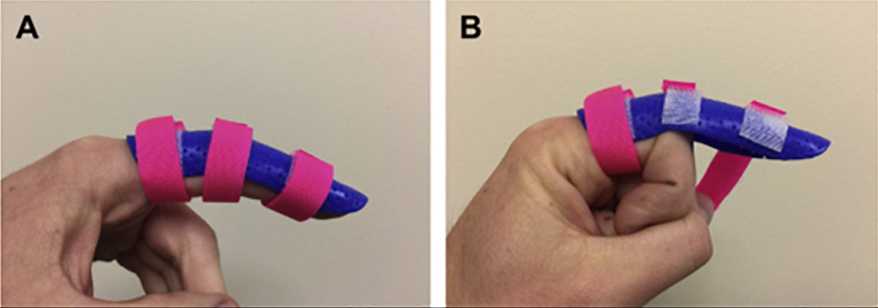 Esguince del dedo. ¿Y ahora qué hago? - TECMA REHABILITACIÓN